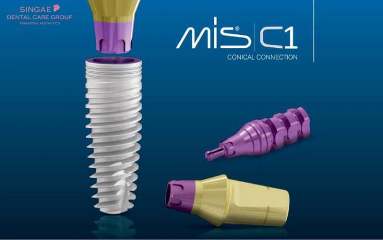 Từ A- Z thông tin về [ Trụ Implant Mis C1 ]: Ưu điểm, giá thành