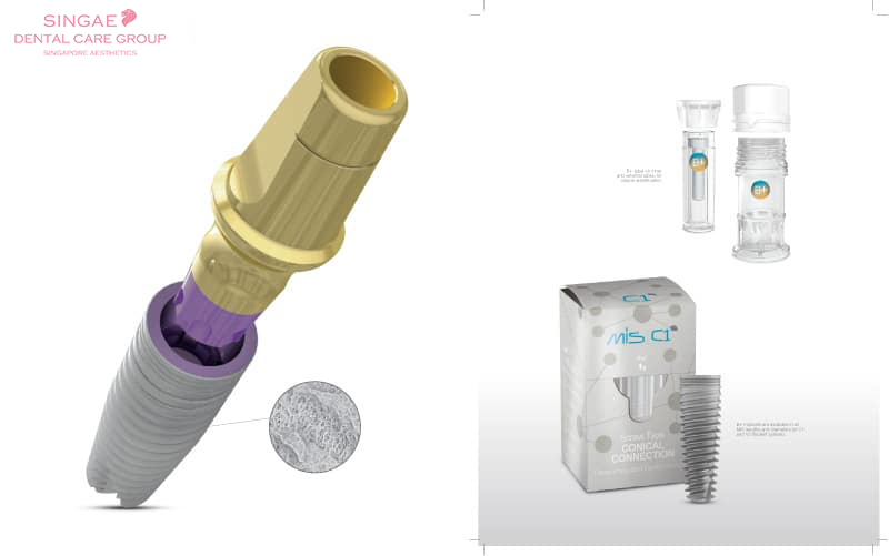 Từ A- Z thông tin về [ Trụ Implant Mis C1 ]: Ưu điểm, giá thành